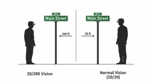 What Is 20/200 Vision? — Meaning, What It Looks Like, Correction ...